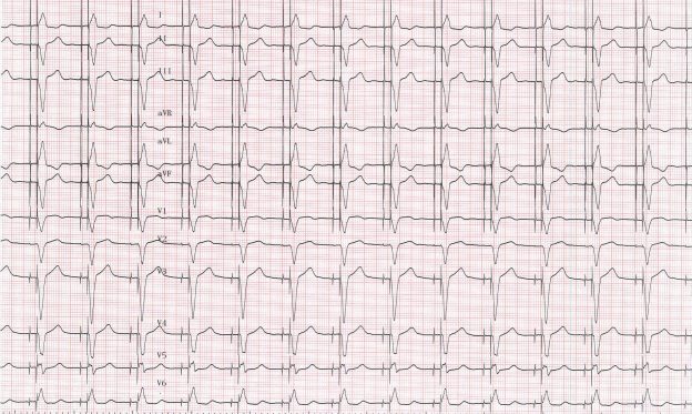 ECG and dual chamber pacemaker - MicroPort Academy