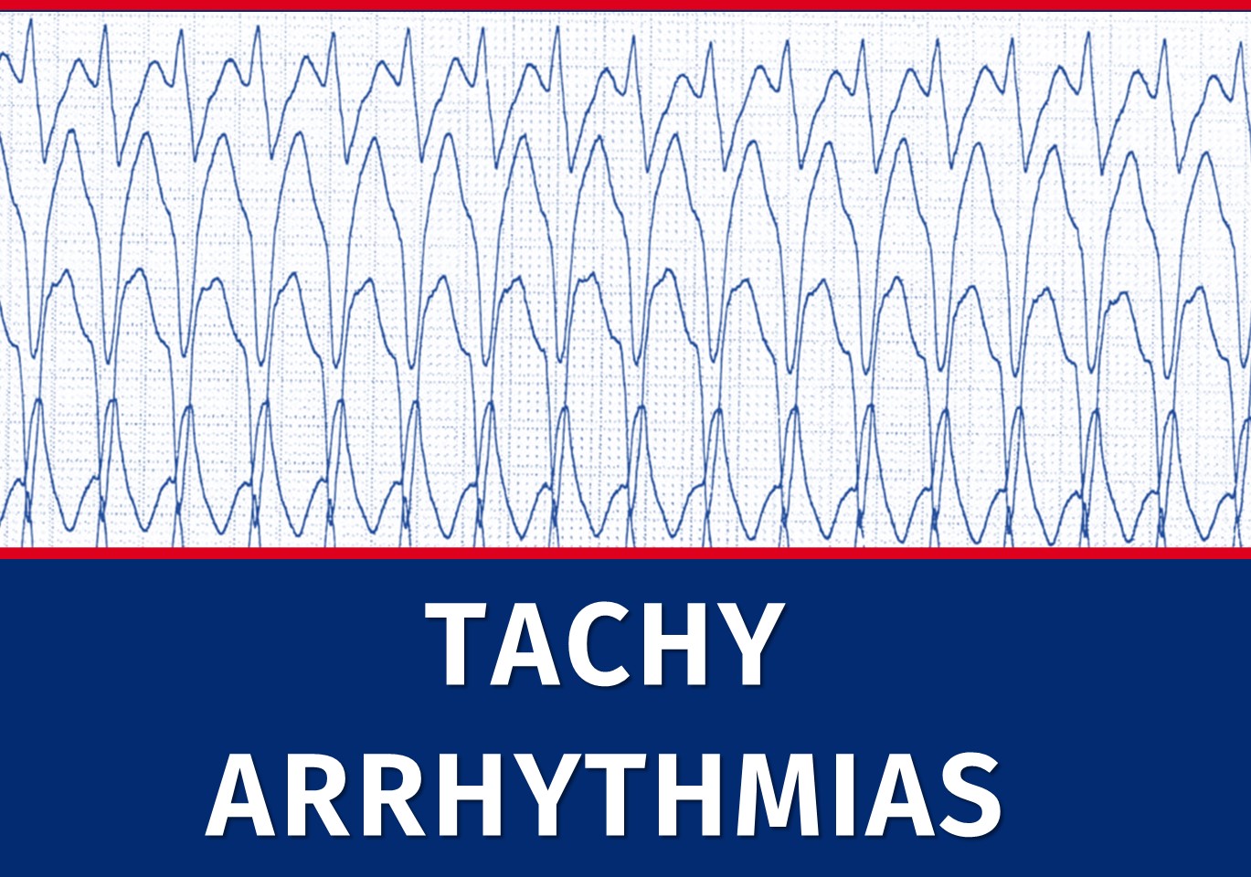 6. Tachyarrhythmias - MicroPort Academy