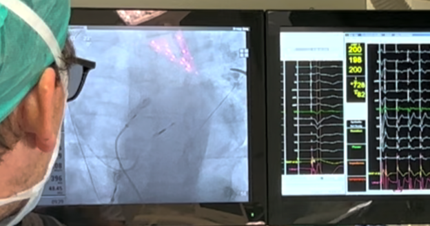 How to perform left bundle branch area pacing - MicroPort Academy