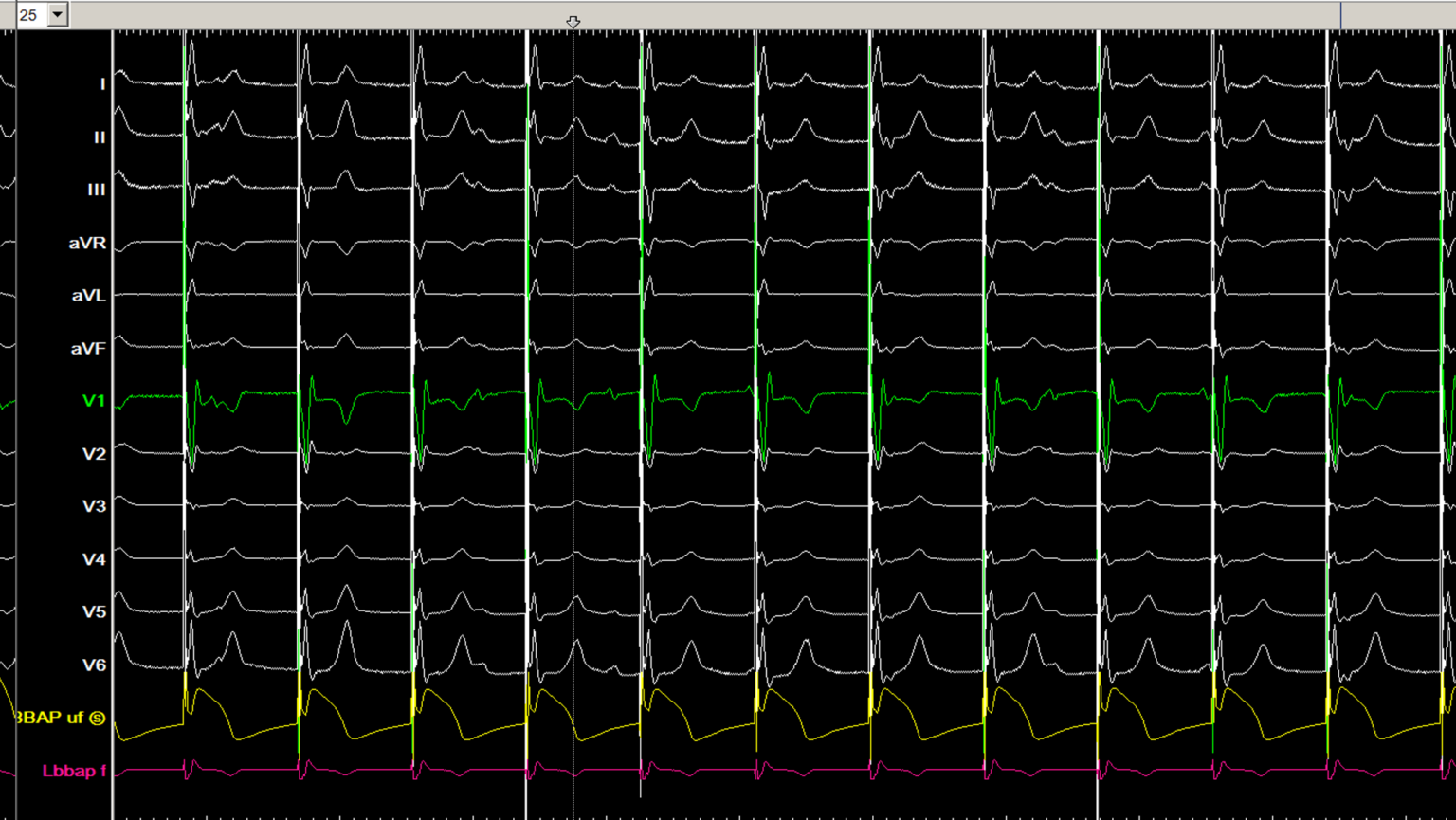 How to perform left bundle branch area pacing - MicroPort Academy