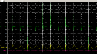 How to perform left bundle branch area pacing - MicroPort Academy