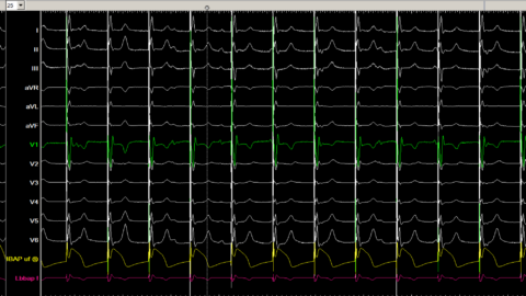How to perform left bundle branch area pacing - MicroPort Academy