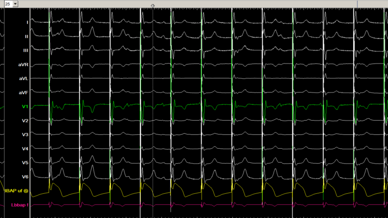 How to perform left bundle branch area pacing - MicroPort Academy